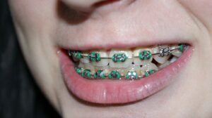 How Fast Do Teeth Move with Braces? - Mouth Ninja
