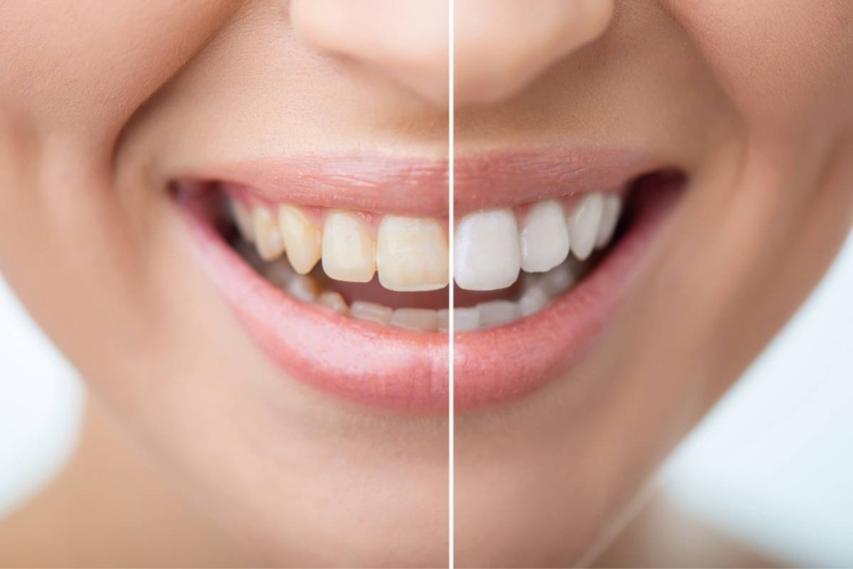 Cosmetic Dentistry for a Perfect Smile - Mouth Ninja